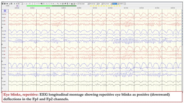 Artifacts in EEG.pptx | Eye and Vision Conditions | Diseases and Conditions