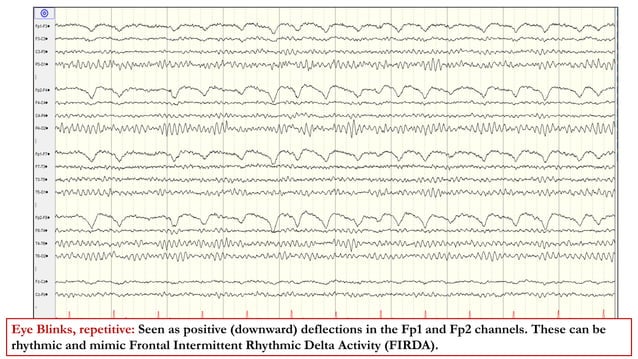Artifacts in EEG.pptx | Eye and Vision Conditions | Diseases and Conditions