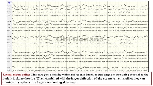Artifacts in EEG.pptx | Eye and Vision Conditions | Diseases and Conditions