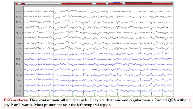 Artifacts in EEG.pptx | Eye and Vision Conditions | Diseases and Conditions