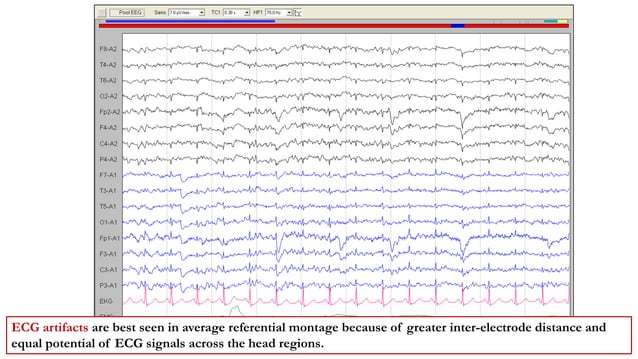 Artifacts in EEG.pptx | Eye and Vision Conditions | Diseases and Conditions
