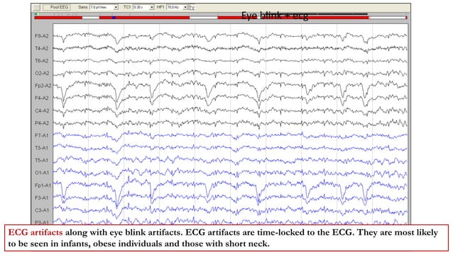 Artifacts in EEG.pptx | Eye and Vision Conditions | Diseases and Conditions
