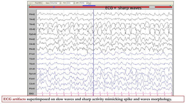 Artifacts in EEG.pptx | Eye and Vision Conditions | Diseases and Conditions