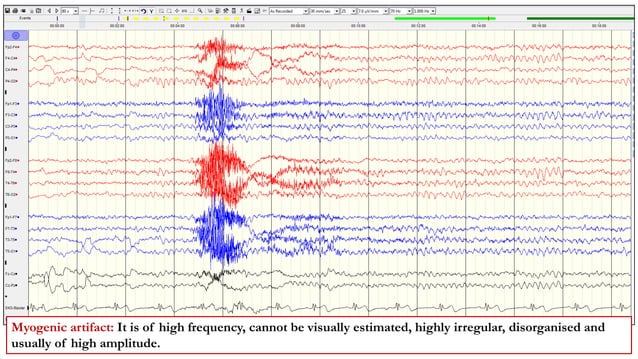 Artifacts in EEG.pptx | Eye and Vision Conditions | Diseases and Conditions