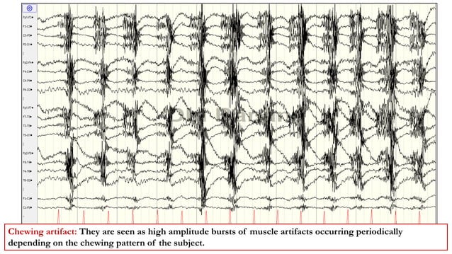 Artifacts in EEG.pptx | Eye and Vision Conditions | Diseases and Conditions