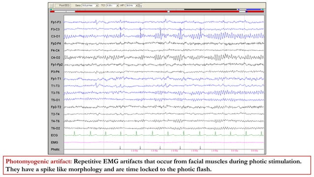 Artifacts in EEG.pptx | Eye and Vision Conditions | Diseases and Conditions