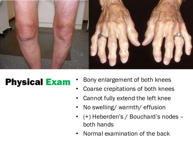 Treatment Decisions in Osteoarthritis