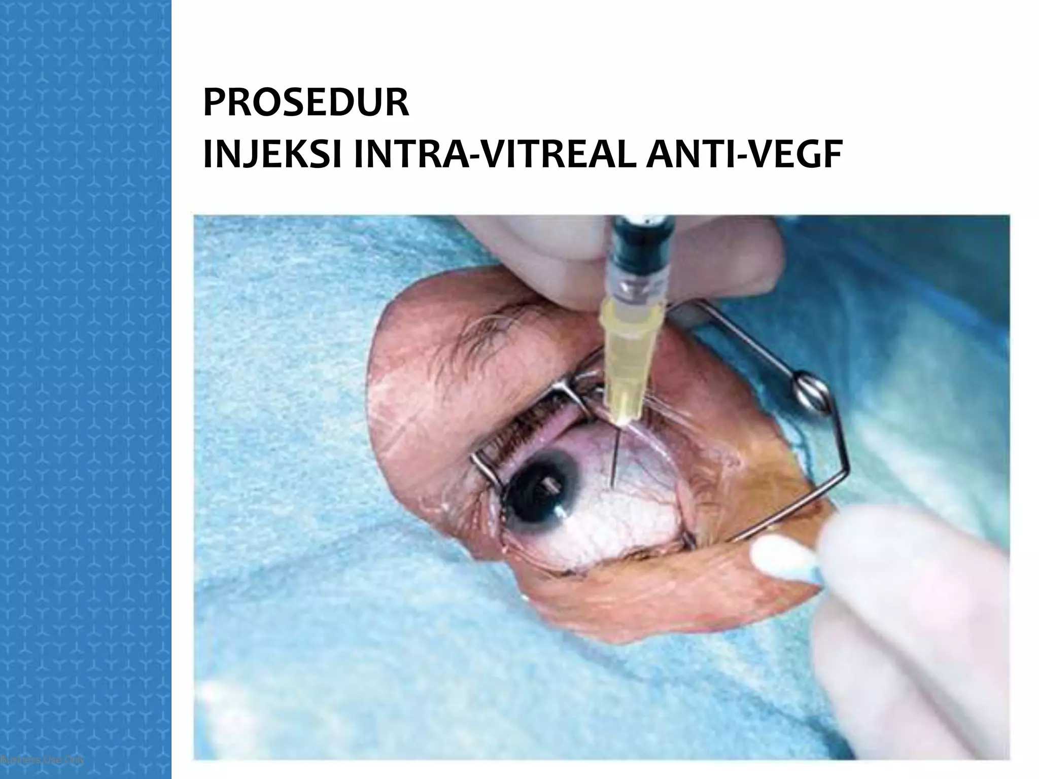 Module injeksi intravitreal.pptx
