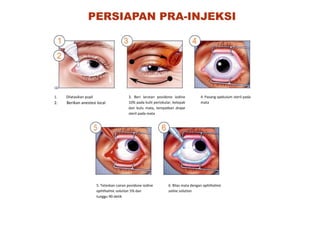 Module injeksi intravitreal.pptx