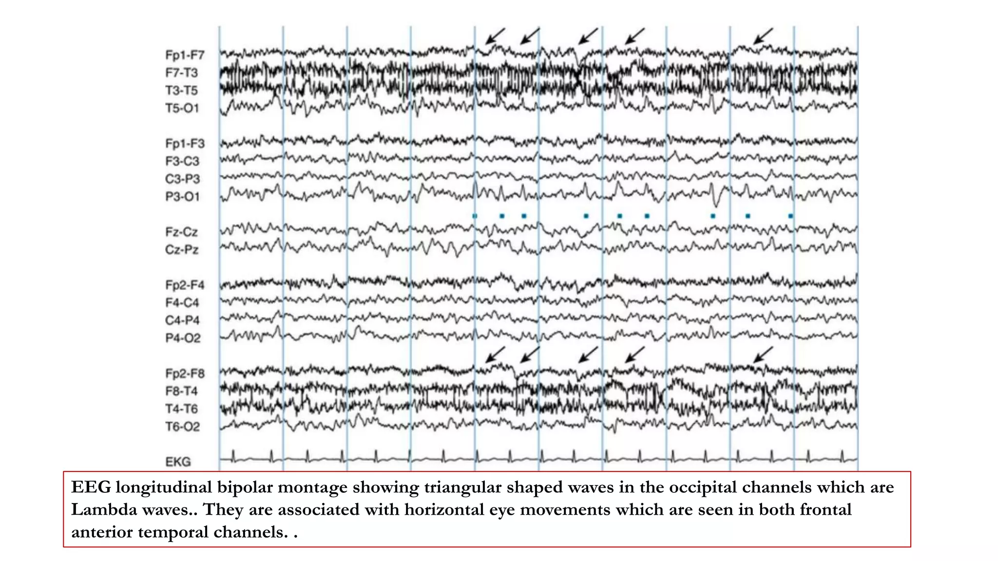 Non epileptiform variants in EEG.pptx
