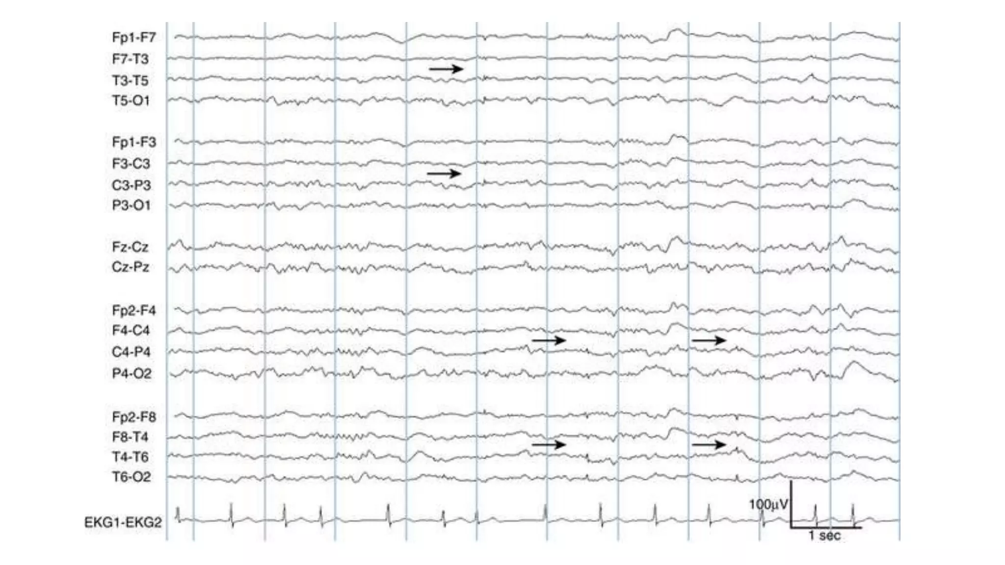 Non epileptiform variants in EEG.pptx