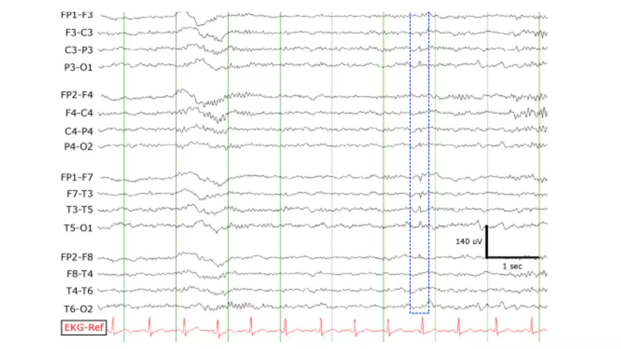 Non epileptiform variants in EEG.pptx