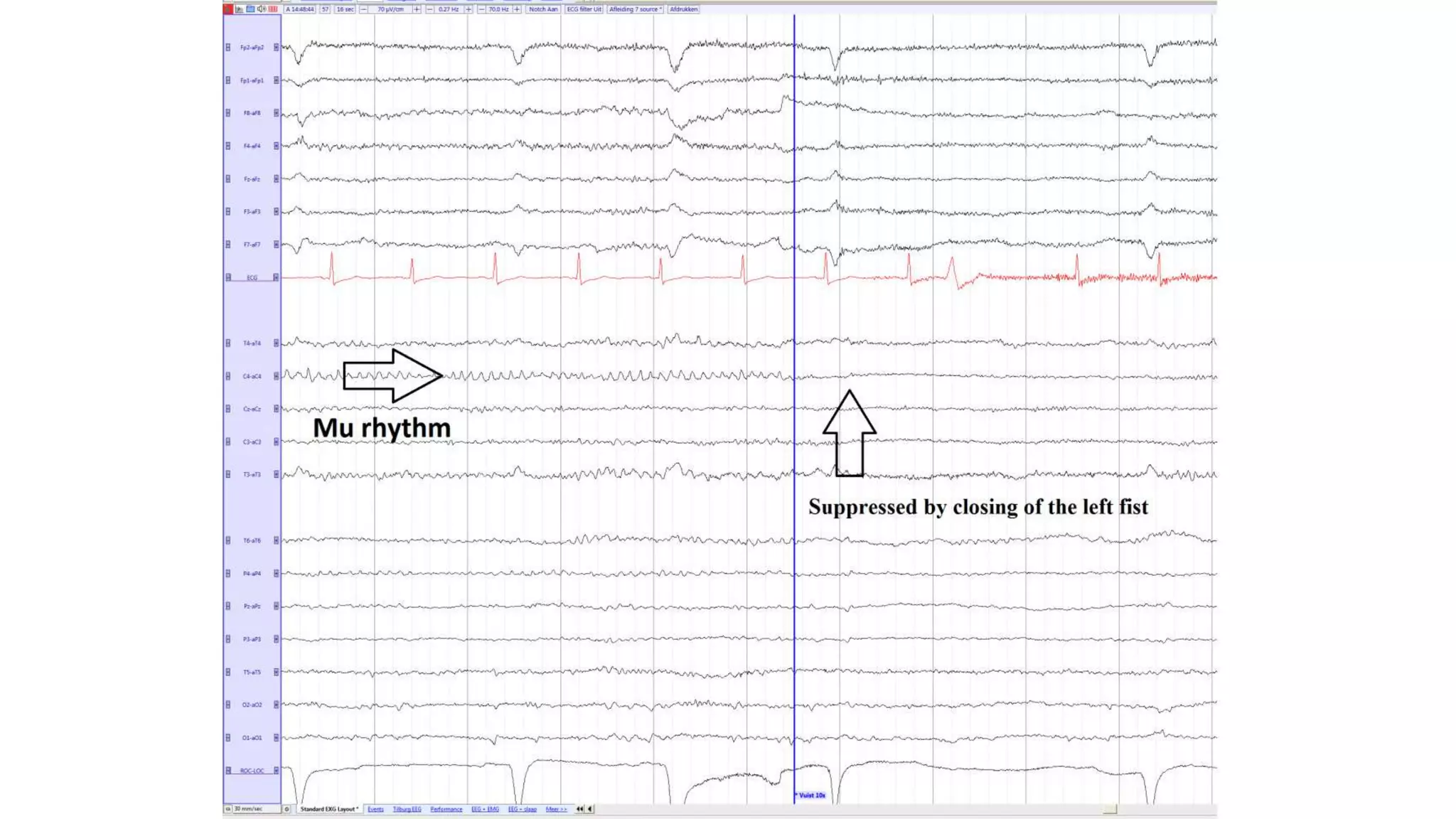 Non epileptiform variants in EEG.pptx
