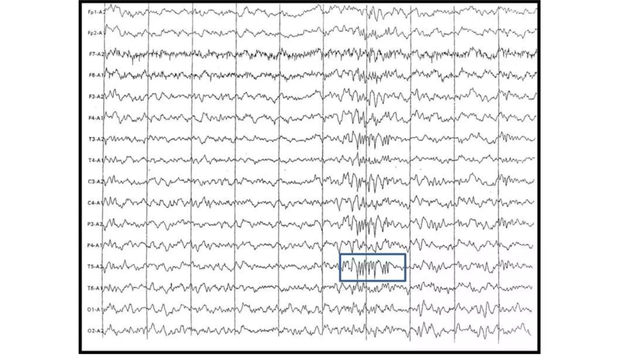Non epileptiform variants in EEG.pptx
