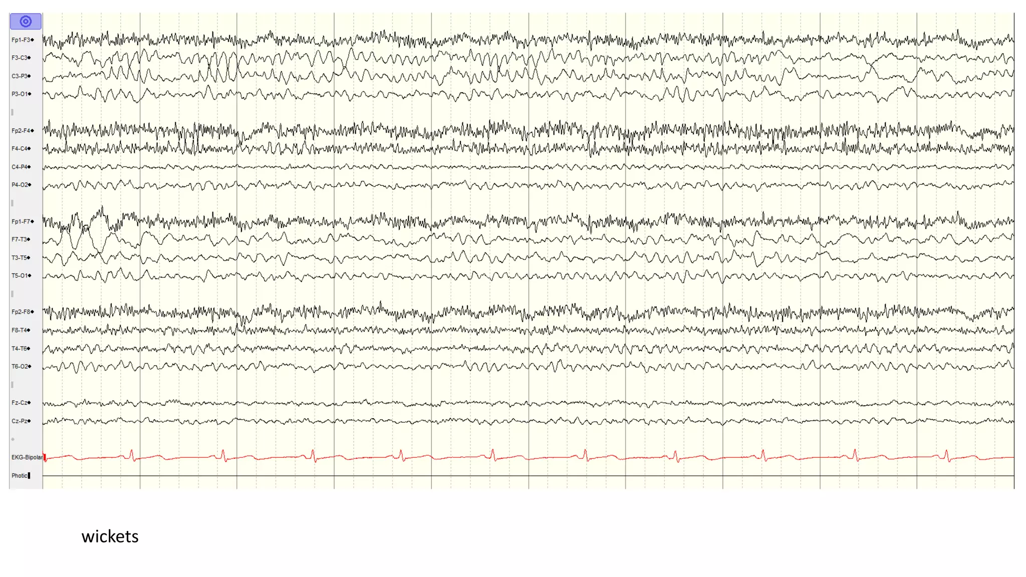 Non epileptiform variants in EEG.pptx | Brain and Nervous System Disorders | Diseases and Conditions