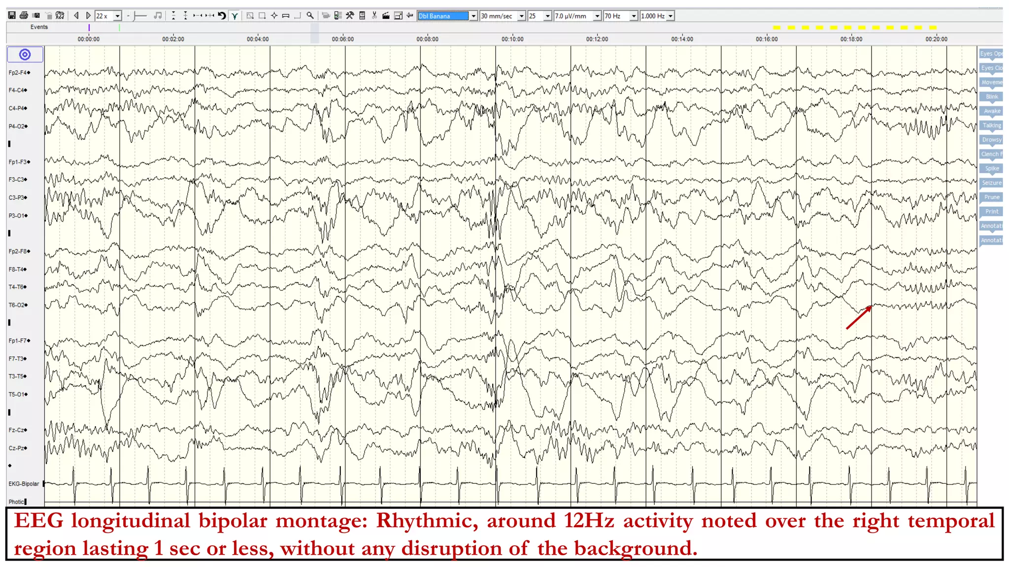 Non epileptiform variants in EEG.pptx | Brain and Nervous System Disorders | Diseases and Conditions