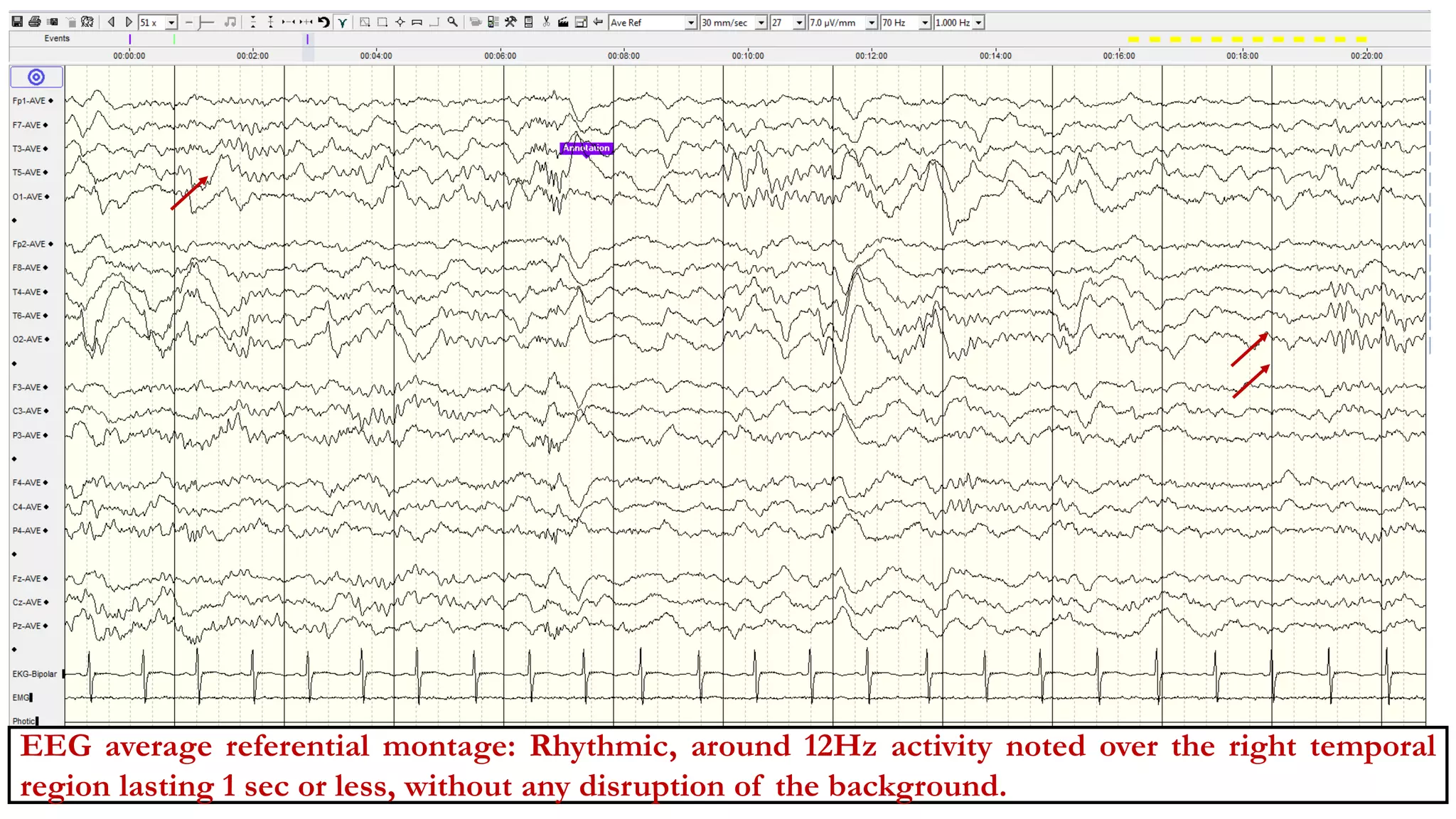 Non epileptiform variants in EEG.pptx | Brain and Nervous System Disorders | Diseases and Conditions