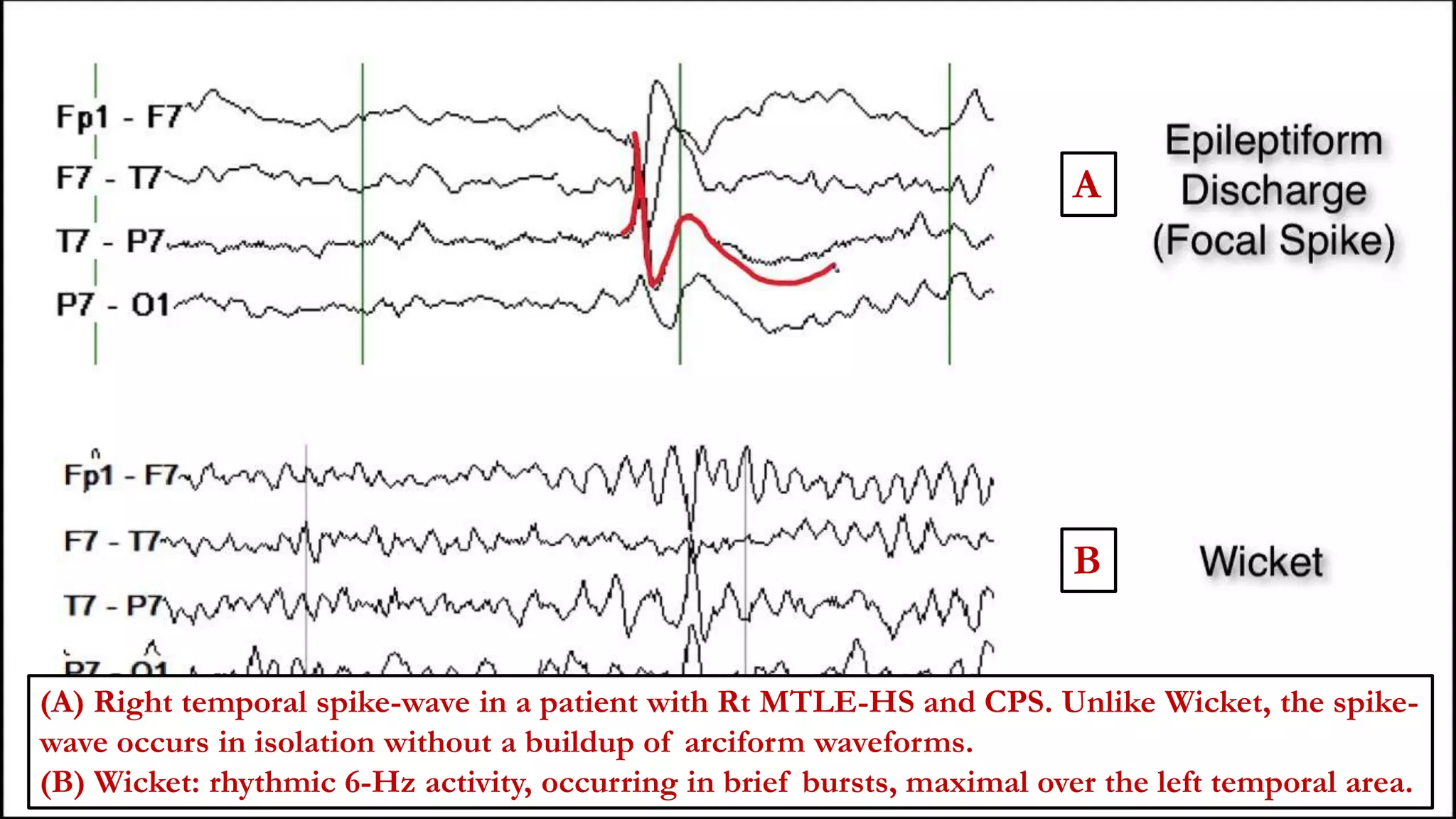 Non epileptiform variants in EEG.pptx