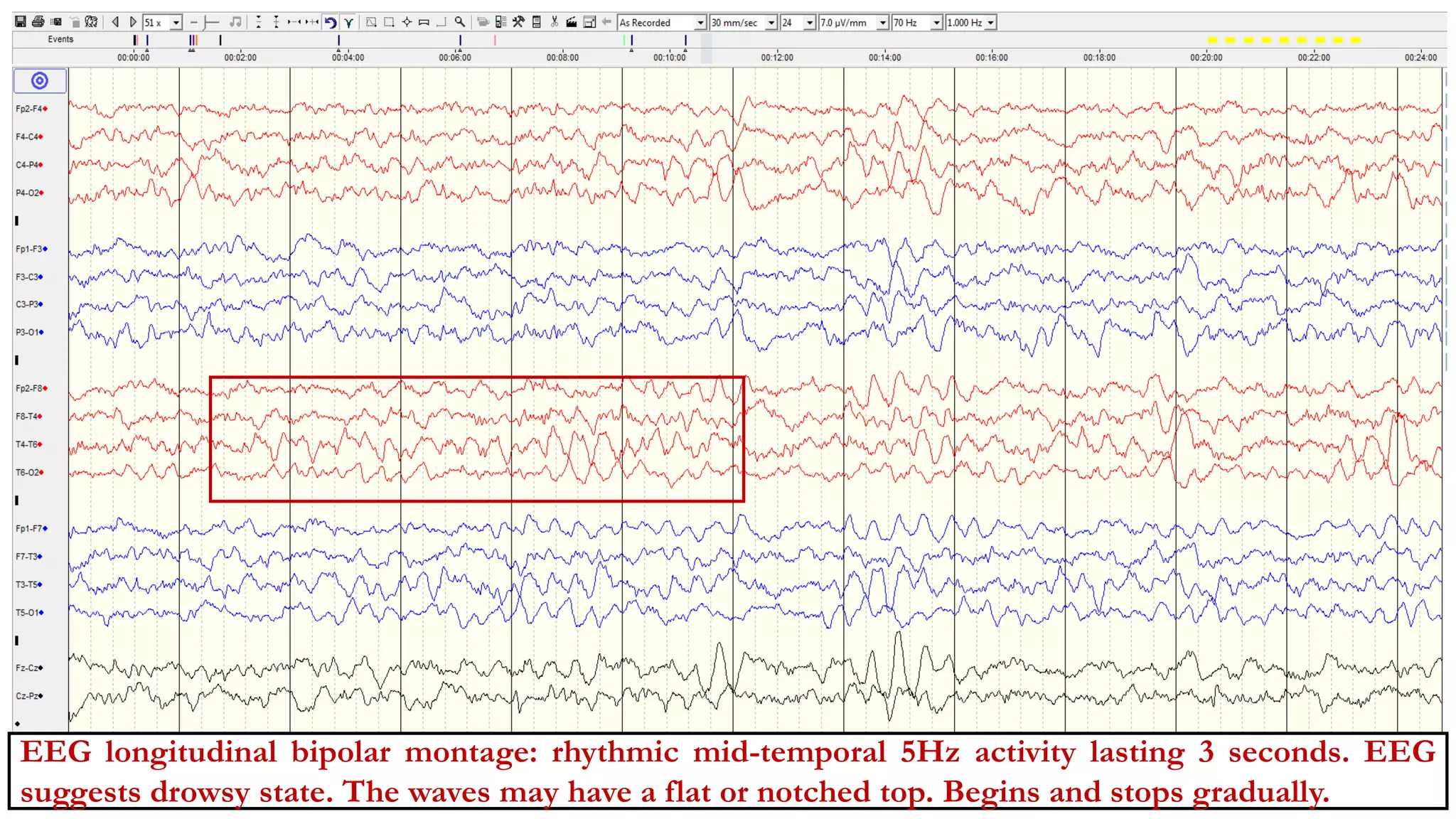 Non epileptiform variants in EEG.pptx | Brain and Nervous System Disorders | Diseases and Conditions
