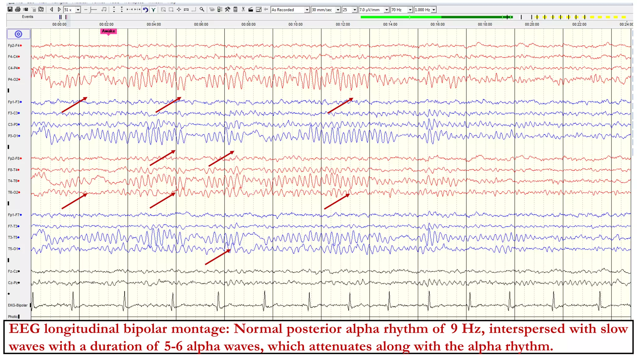 Non epileptiform variants in EEG.pptx | Brain and Nervous System ...