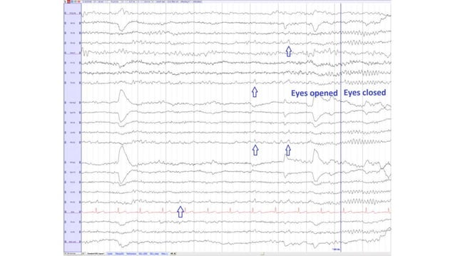 Non epileptiform variants in EEG.pptx | Brain and Nervous System Disorders | Diseases and Conditions