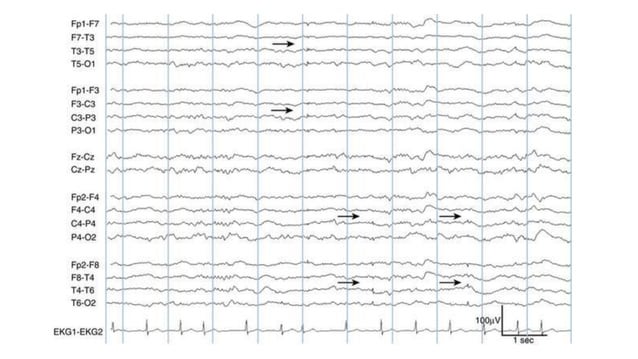 Non epileptiform variants in EEG.pptx | Brain and Nervous System ...