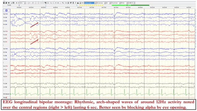 Non epileptiform variants in EEG.pptx | Brain and Nervous System Disorders | Diseases and Conditions