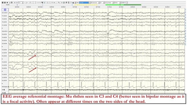 Non epileptiform variants in EEG.pptx | Brain and Nervous System ...