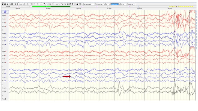 Non epileptiform variants in EEG.pptx | Brain and Nervous System Disorders | Diseases and Conditions