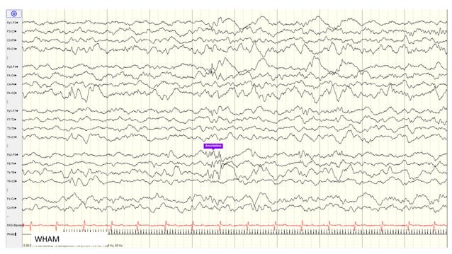 Non epileptiform variants in EEG.pptx | Brain and Nervous System Disorders | Diseases and Conditions