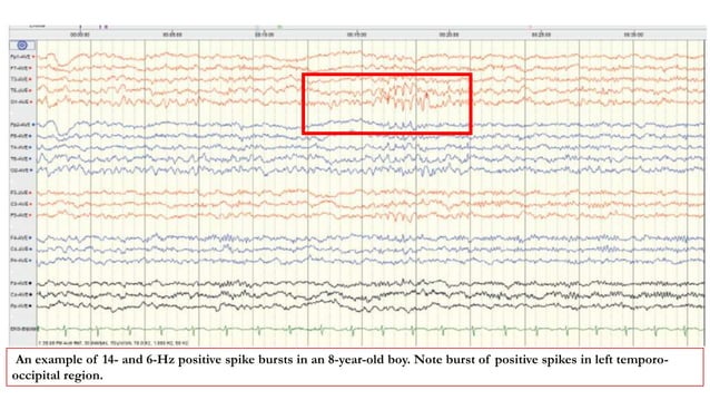 Non epileptiform variants in EEG.pptx | Brain and Nervous System ...