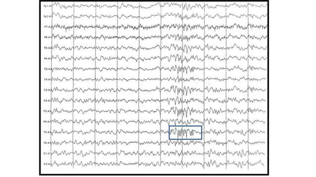 Non epileptiform variants in EEG.pptx | Brain and Nervous System Disorders | Diseases and Conditions