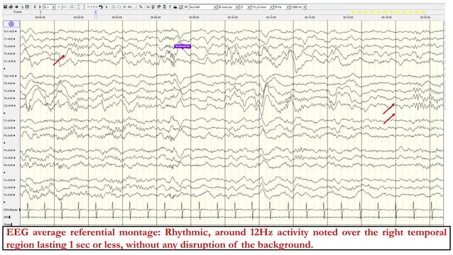 Non epileptiform variants in EEG.pptx | Brain and Nervous System ...