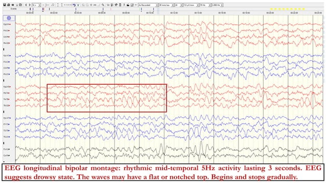 Non epileptiform variants in EEG.pptx | Brain and Nervous System Disorders | Diseases and Conditions