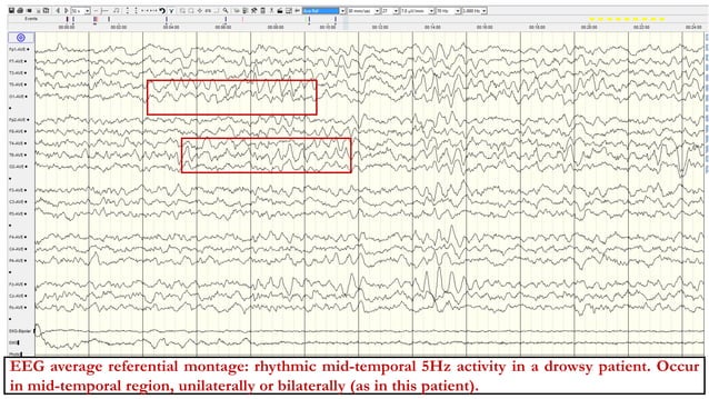 Non epileptiform variants in EEG.pptx | Brain and Nervous System ...