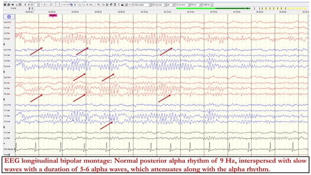 Non epileptiform variants in EEG.pptx | Brain and Nervous System ...