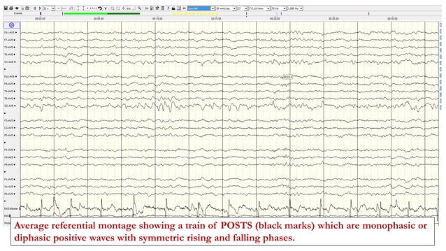 Non epileptiform variants in EEG.pptx | Brain and Nervous System ...