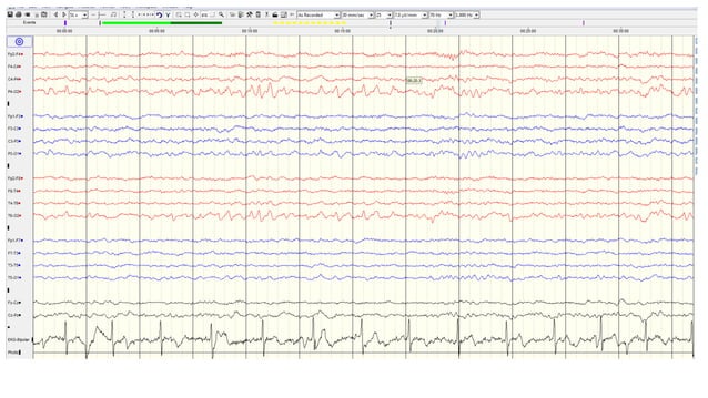 Non epileptiform variants in EEG.pptx | Brain and Nervous System ...