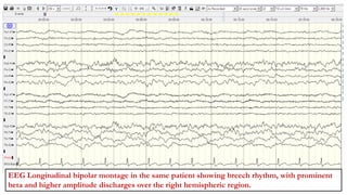 Non epileptiform variants in EEG.pptx