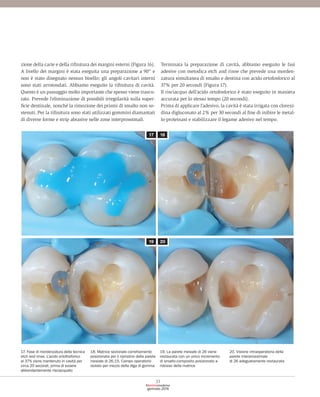 Odontoiatria Adesiva - Primo Modulo | PDF