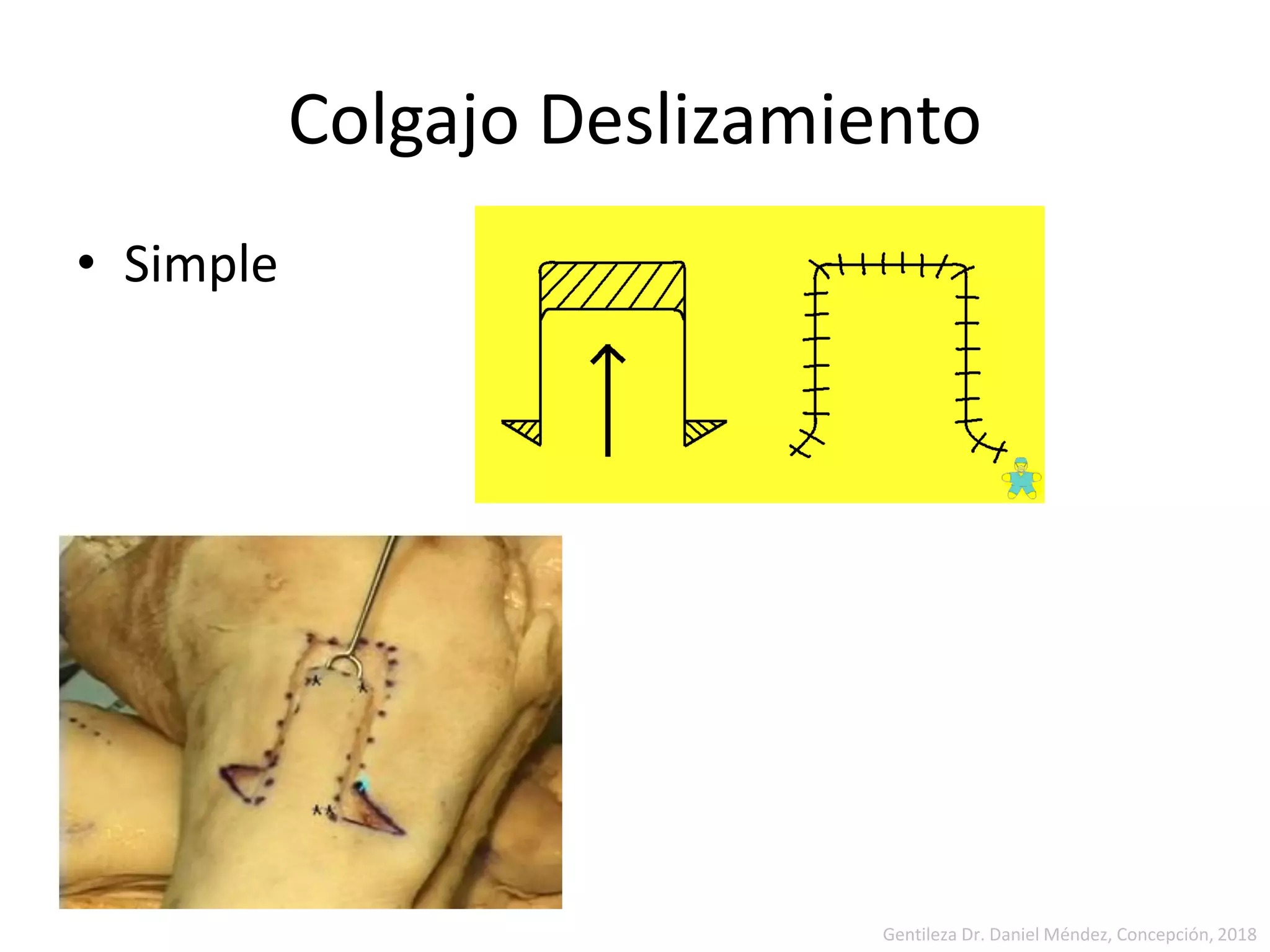 Modulo teorico 4 colgajos cutaneos | PDF