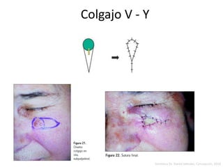 Modulo teorico 4 colgajos cutaneos | PDF