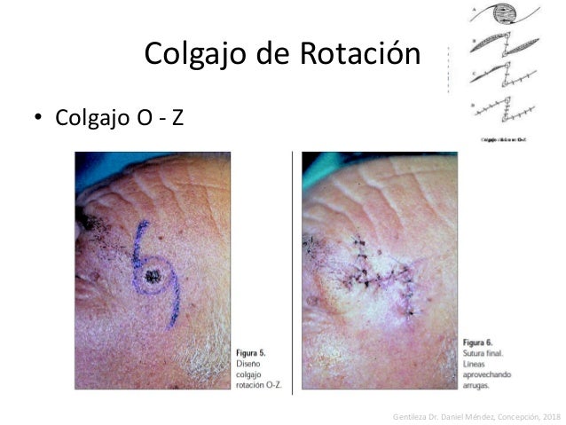 Modulo teorico 4 colgajos cutaneos