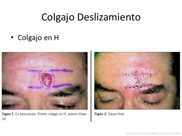 Modulo teorico 4 colgajos cutaneos