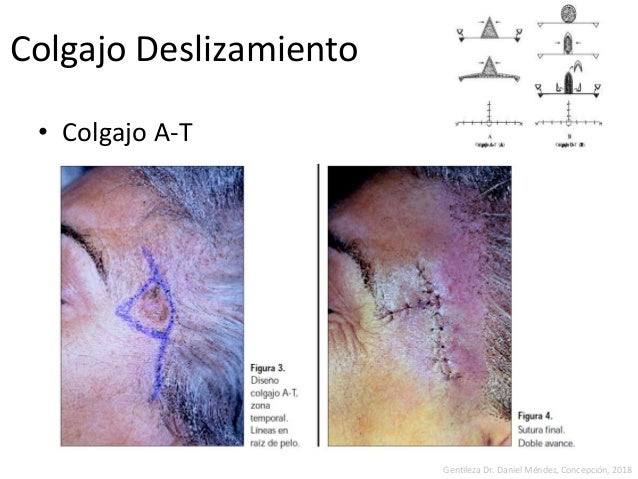 Modulo teorico 4 colgajos cutaneos