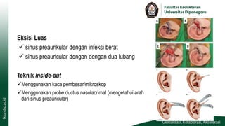 Modul_Otologi_Fistula preauricular_Selasa_20-06-23.pptx