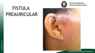 Modul_Otologi_Fistula preauricular_Selasa_20-06-23.pptx