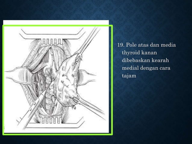 total tiroidektomi | PPTX