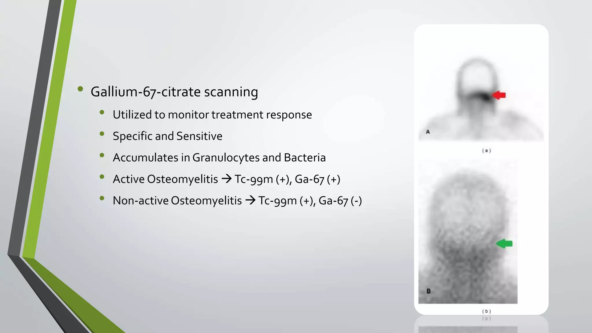 Malignant Otitis Externa/ Skull Base osteomyelitis | PPTX