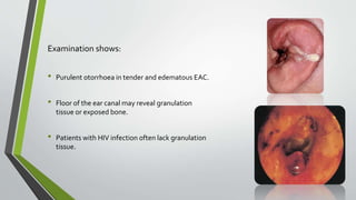 Malignant Otitis Externa/ Skull Base osteomyelitis | PPTX